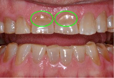 What is Tooth Erosion? Symptoms, Causes and Prevention