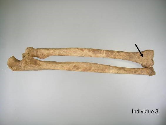 OSTEOLOGIA: Practico N°IV Osteología de MMS MMII