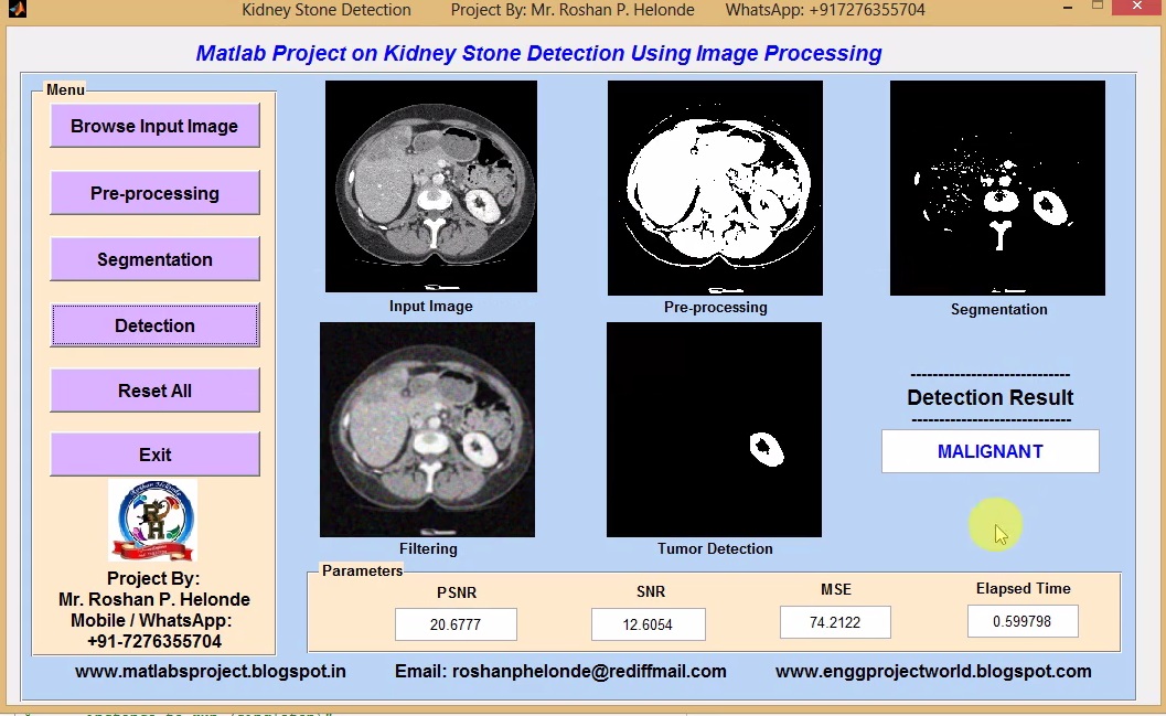Kidney Stone Detection Using Image Processing Matlab Project with ...