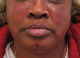 Coping With Lupus: What is Butterfly Rash?