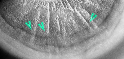Modern & Multidimensional Iridology: Radial Furrows Intercepting with ...