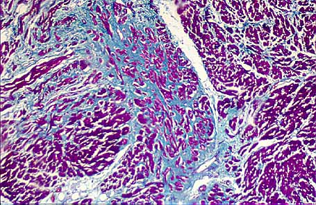 Patología 2013: MIOCARDIOPATÍAS