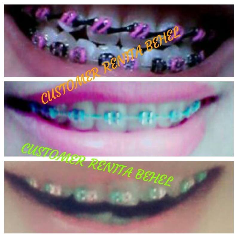 Behel Gigi Murah Batam: Mei 2016