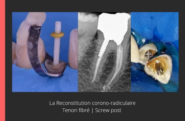 Protocole de reconstitution corono-radiculaire foulée - MEGA dentist