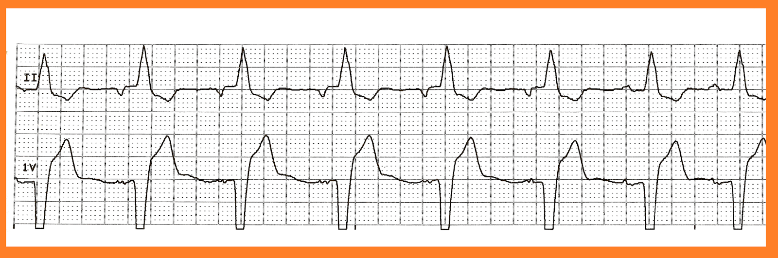 EKG Rhythm Quiz 224