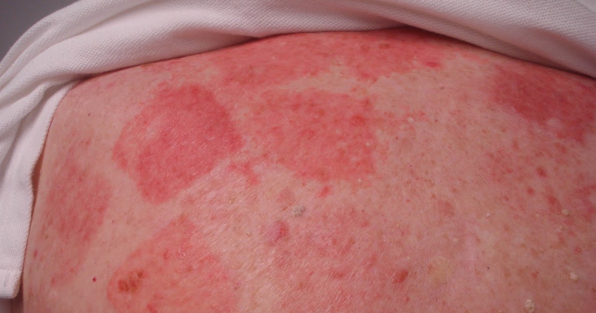 VIRTUAL GRAND ROUNDS IN DERMATOLOGY 2.0: Rotigotine Contact Dermatitis