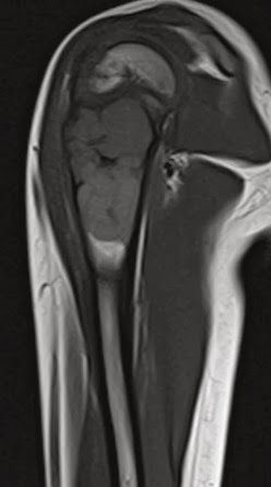 RADIODIAGNOSIS - IMAGE COLLECTION: SIMPLE BONE CYST