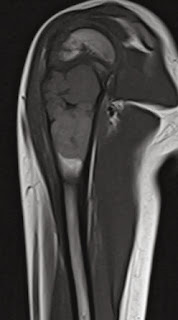 RADIODIAGNOSIS - IMAGE COLLECTION: SIMPLE BONE CYST