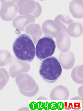 [Haematology] Abnormalities of the White Cell Series | Free Medical Atlas