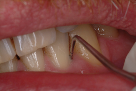 Blogs van Tandartspraktijk Top Dental: Bloedend tandvlees, hoe komt dat?