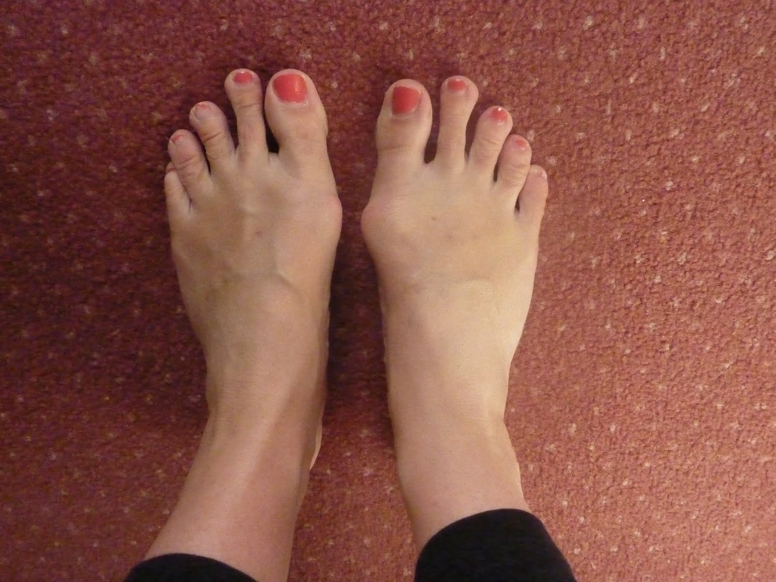 From bunions to beautiful feet: October 2012