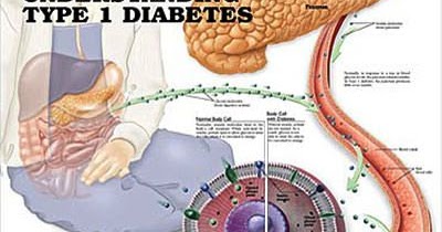 Blood Sugar Secret: Understanding Type 1 Diabetes