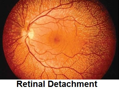 Retinal Detachment: Causes, Symptoms, Diagnosis And Treatment | Health ...