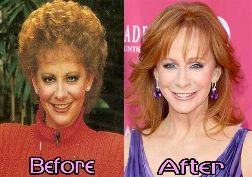Reba McEntire Plastic Surgery