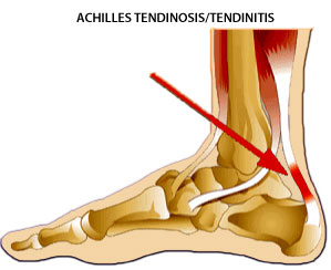 Heel Spur Symptoms - Achilles Tendonitis Symptoms - Health and Fitness Tips