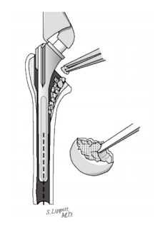 Shoulder and Elbow Surgery: Impaction autografting of the medial calcar ...