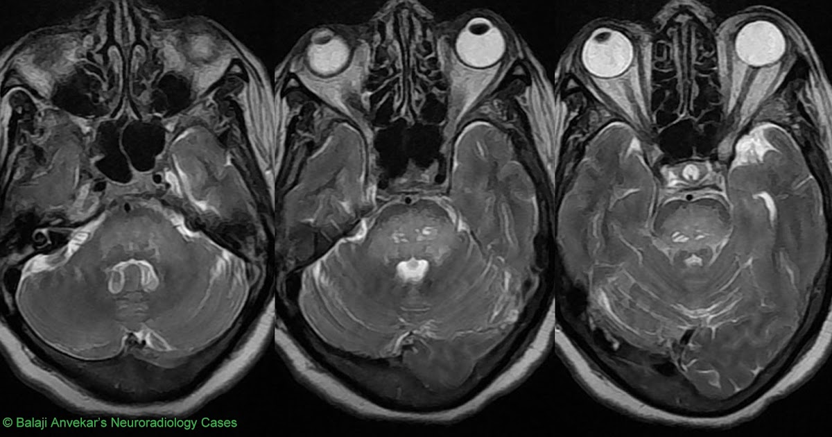 Neuroradiology Cases: Central Pontine Myelinolysis