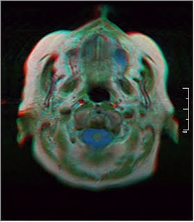 Nevit's blog: False-color Brain MRI (Motion artifacts)
