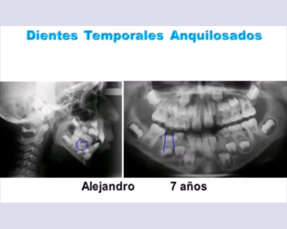 Anquilosis en Odontopediatría - Diagnóstico, clasificación y manejo ...