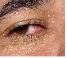 Doctors Gates: Illustrated photos of Milia