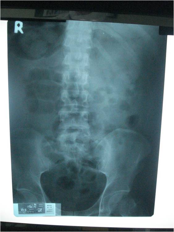 Proyeksi pemeriksaan Abdomen 3 posisi | Aditya Radiografer