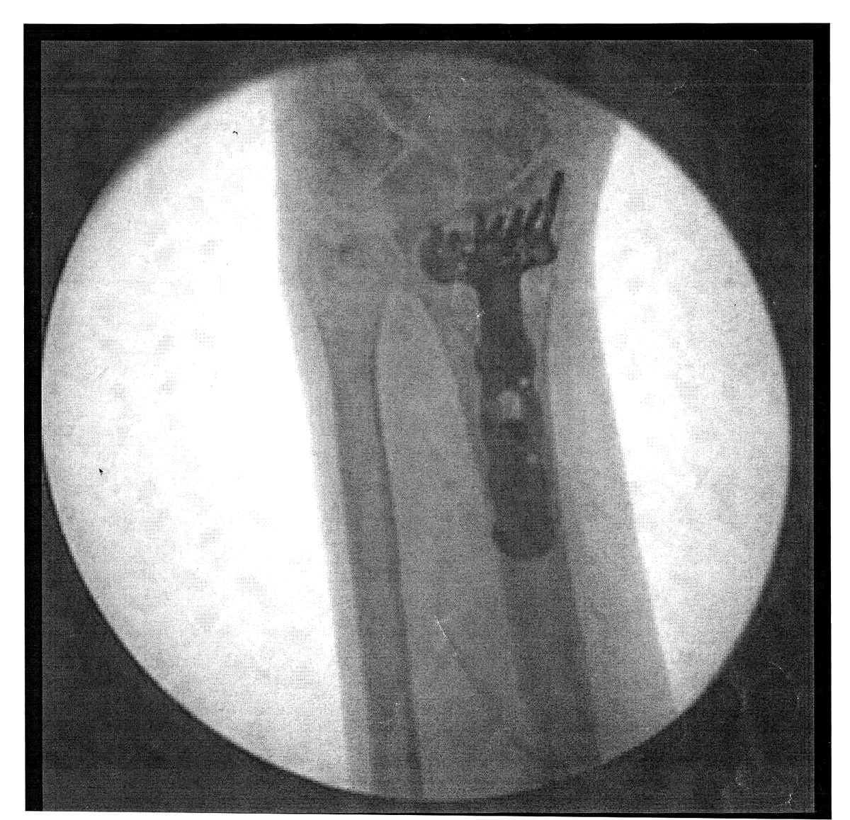 The View From Here: My Titanium Wrist