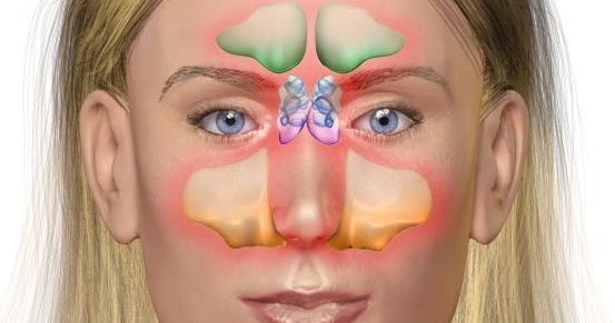 Chronic Sinusitis - Symptoms And Causes