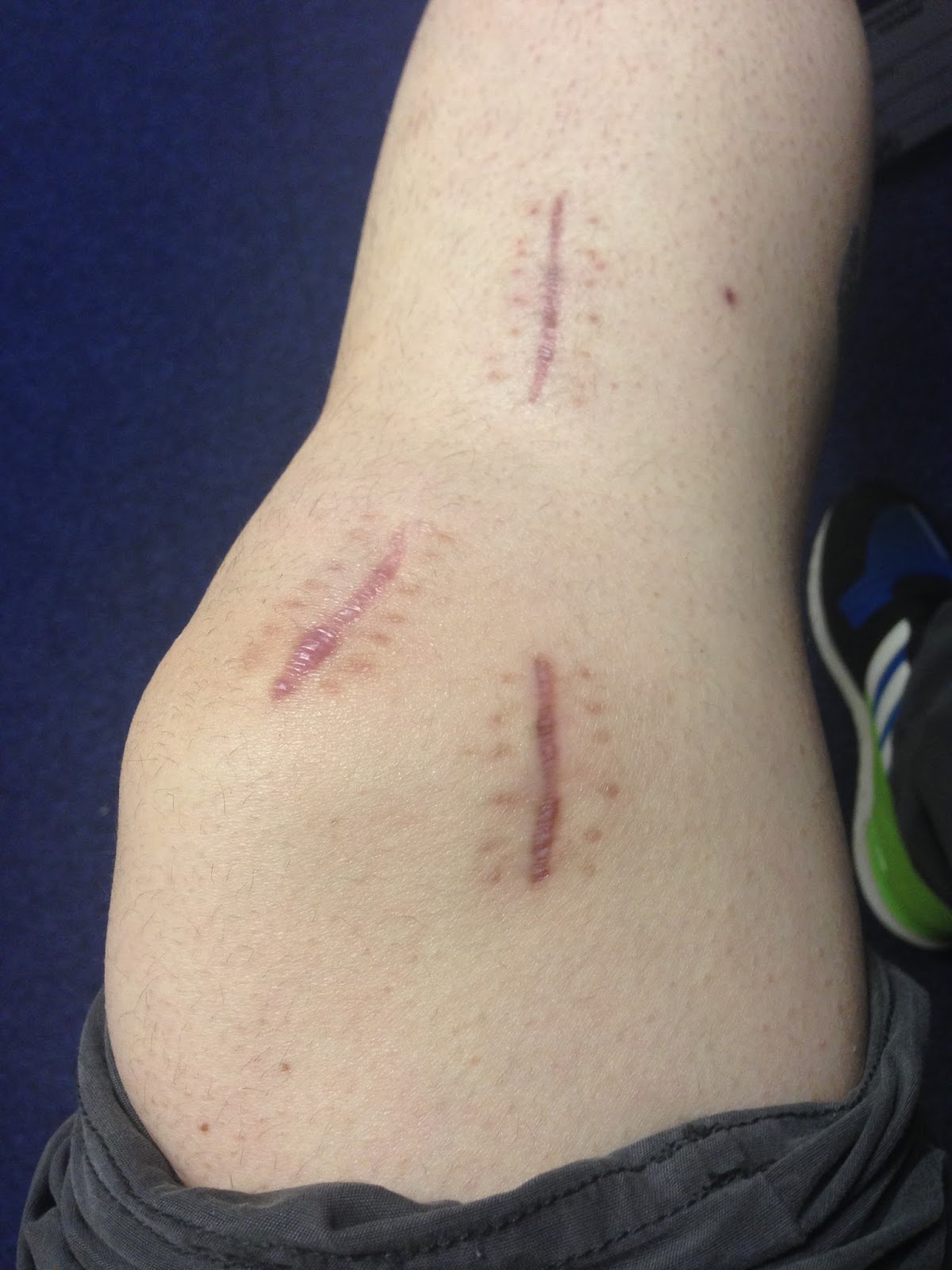 My Experience Having MPFL Reconstruction Surgery