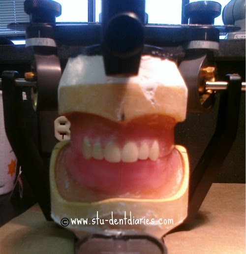 Stu-DENT Diaries: Setting Mandibular Anterior Teeth