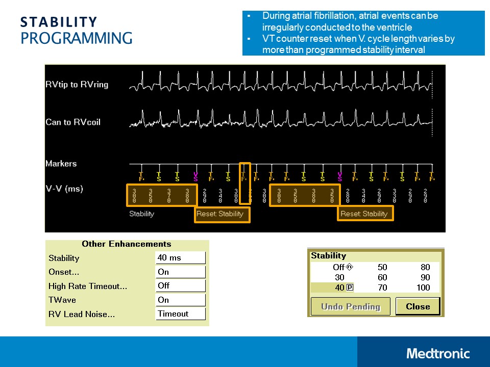 CVT Mohd Farid: Concept Of ICD Technology-SVT Discrimination Algorithms ...
