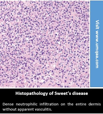 What is Sweet syndrome?