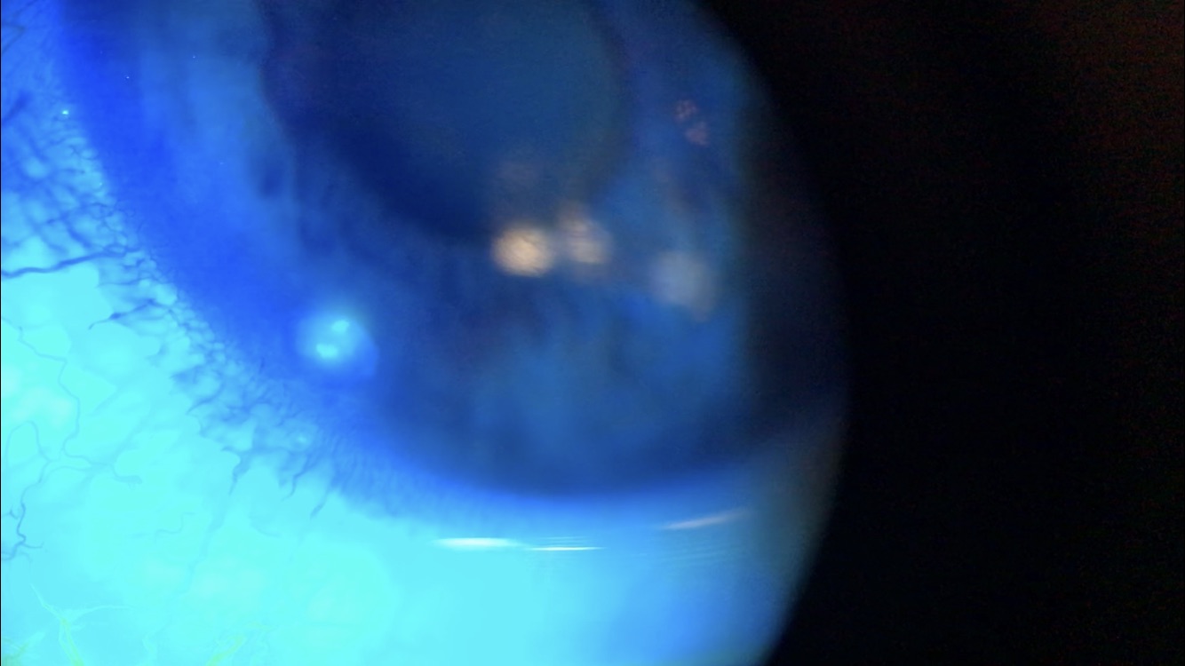 Sonoran Desert Eye Center: MARGINAL CORNEAL ULCER