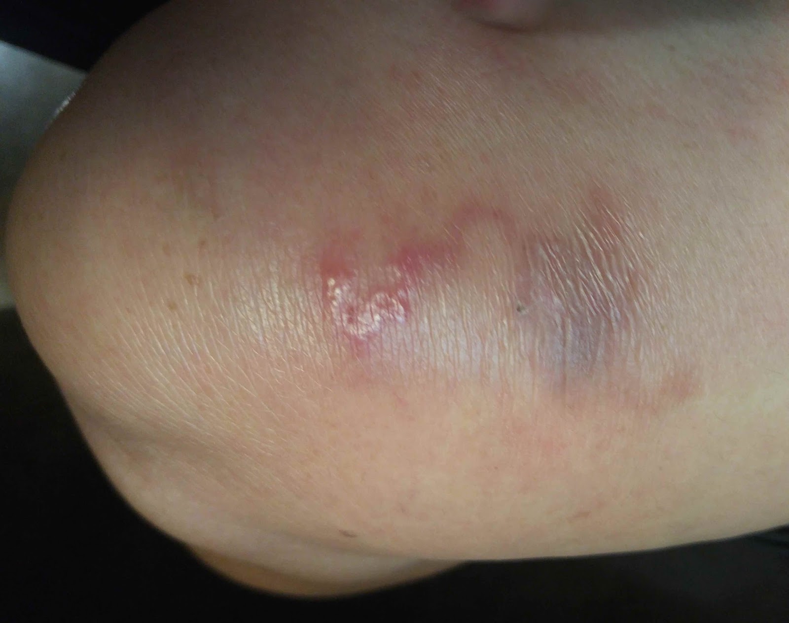 Creeping Eruption (Cutaneous Larva Migrans) : penyakit lama yang muncul ...