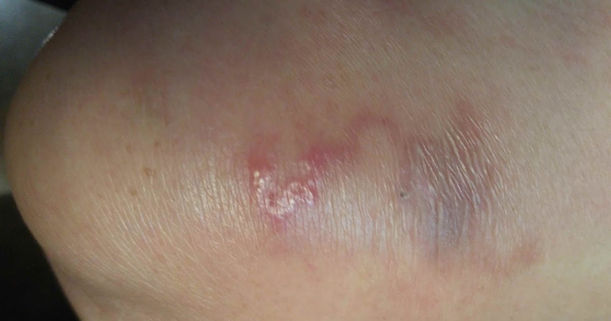 Creeping Eruption (Cutaneous Larva Migrans) : penyakit lama yang muncul ...