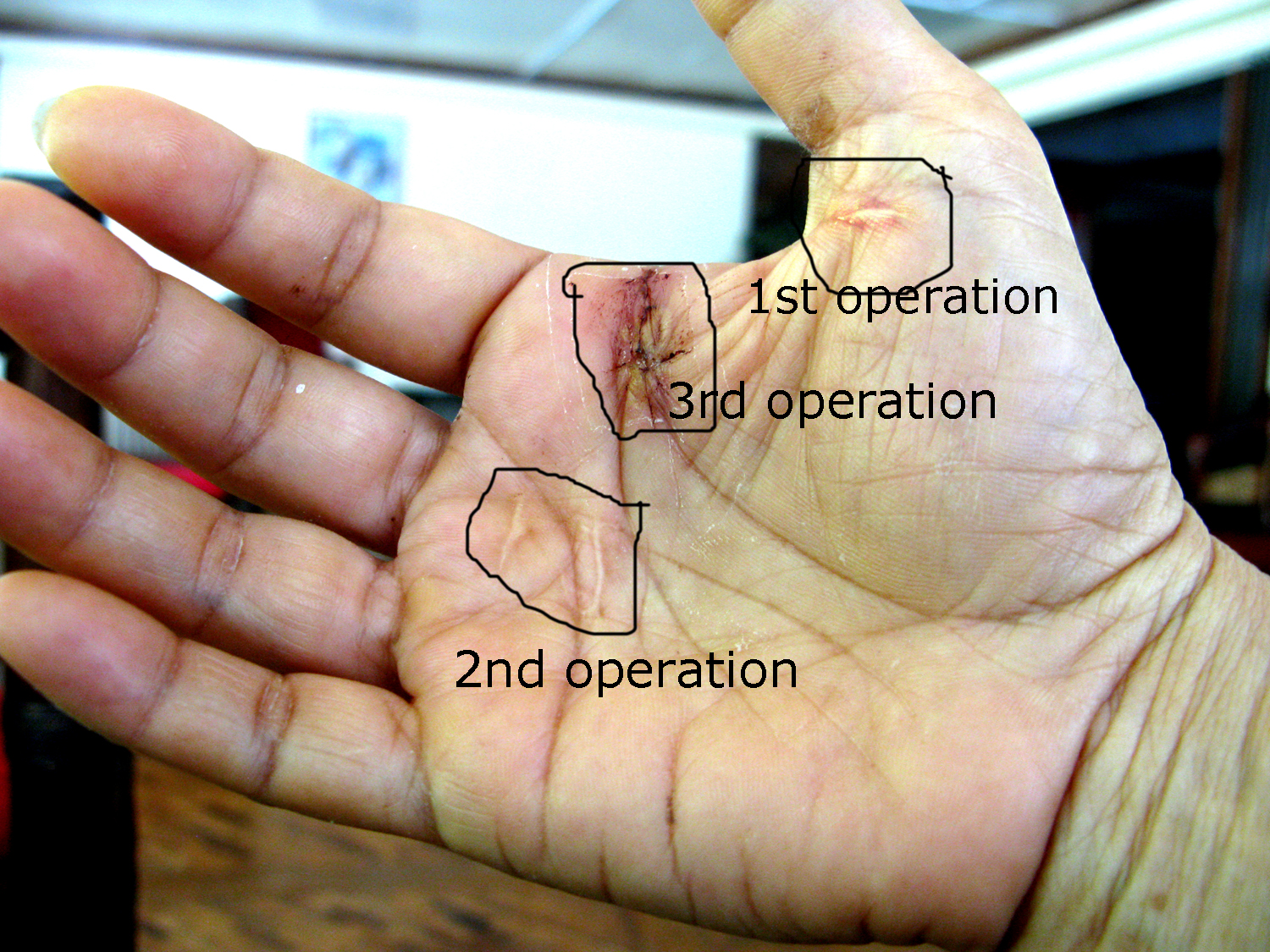 Swimming and Floating: Trigger Finger, Gotcha! Ouch.........