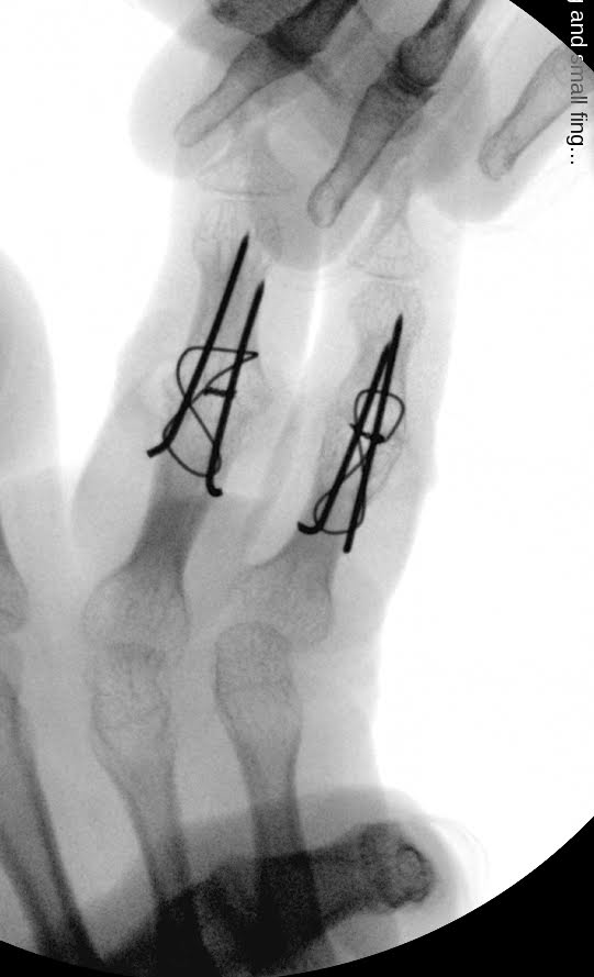 Severe Camptodactyly | Congenital Hand and Arm Differences | Washington ...