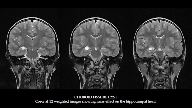 Ultimate Radiology : Choroid Fissure Cyst