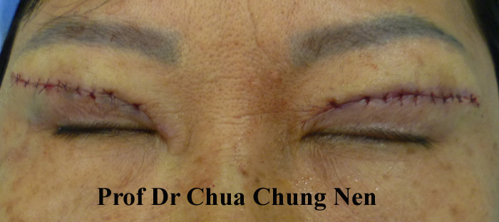 Eyelid Surgery by Prof Dr CN CHUA 蔡鐘能: Doc, Can You Remove the Excess ...