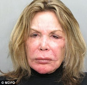 Elsa Patton Plastic Surgery Gone Wrong Before and After Botox ...