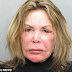 Elsa Patton Plastic Surgery Gone Wrong Before and After Botox ...