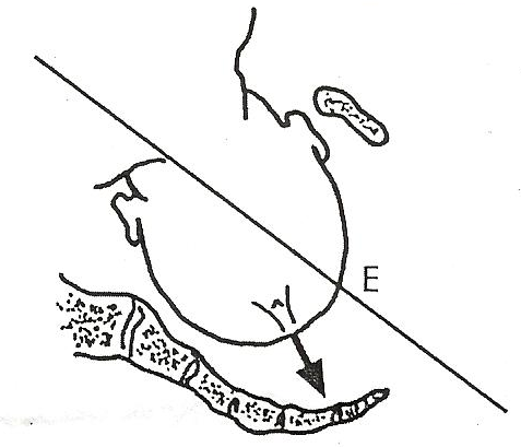 Bio Gestacional: Imagenes Sinclitismo y Asinclitismo