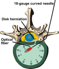 Donna: 980nm Laser PLDD Treatment