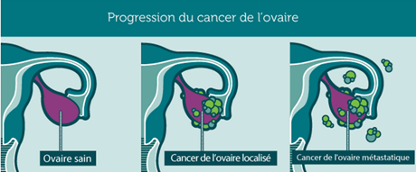 Actualités Scientifiques - Médicales: #thelancetoncology #cancerovarien ...