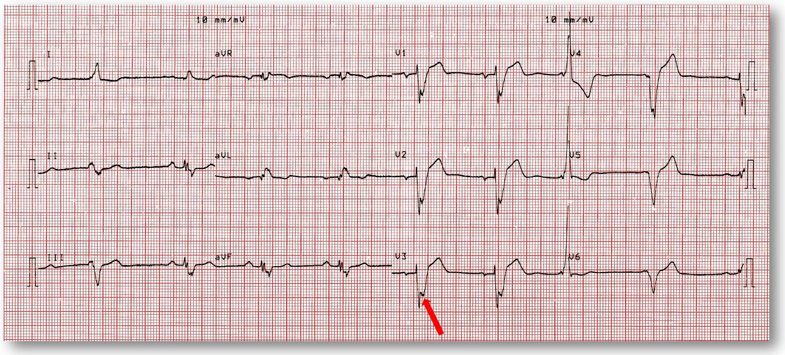 Andrew R. Houghton: Cabrera's sign and the diagnosis of old MI in LBBB