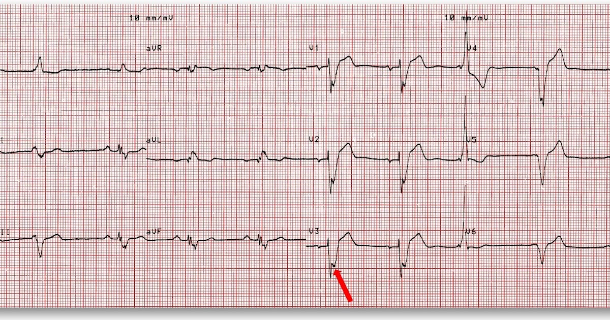 Andrew R. Houghton: Cabrera's sign and the diagnosis of old MI in LBBB