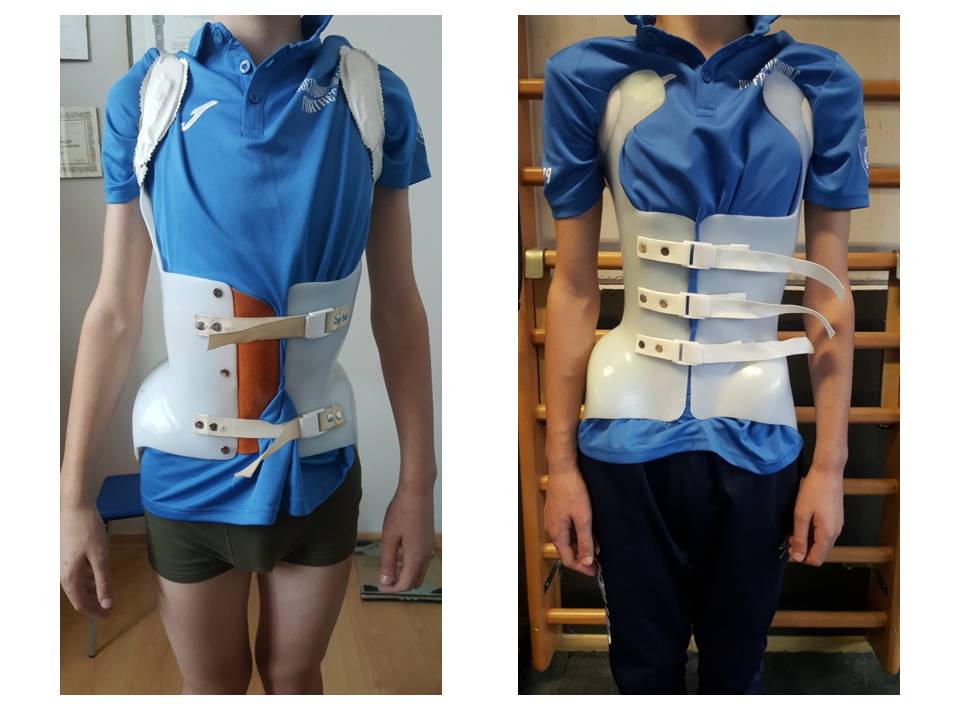 Despre corsetul Cheneau :: Corset scolioza / scoliosis braces