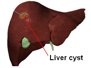 Liver Cyst Causes And Symptoms - What Is A Liver cyst? | Health And Beauty