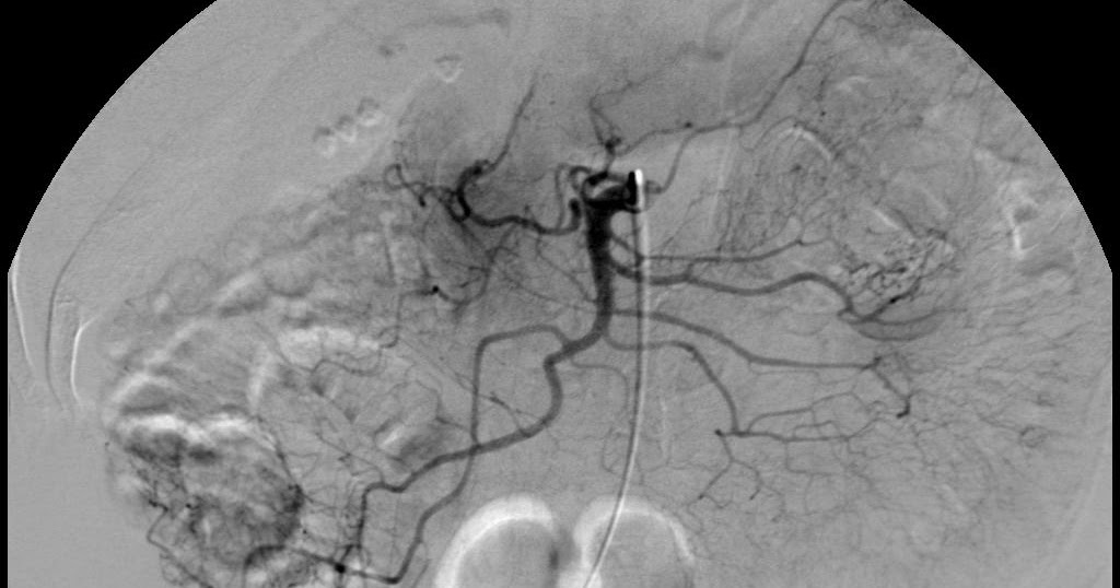 Interventional Radiology Casebook: Lower GI bleed ... Angiodysplasia ...