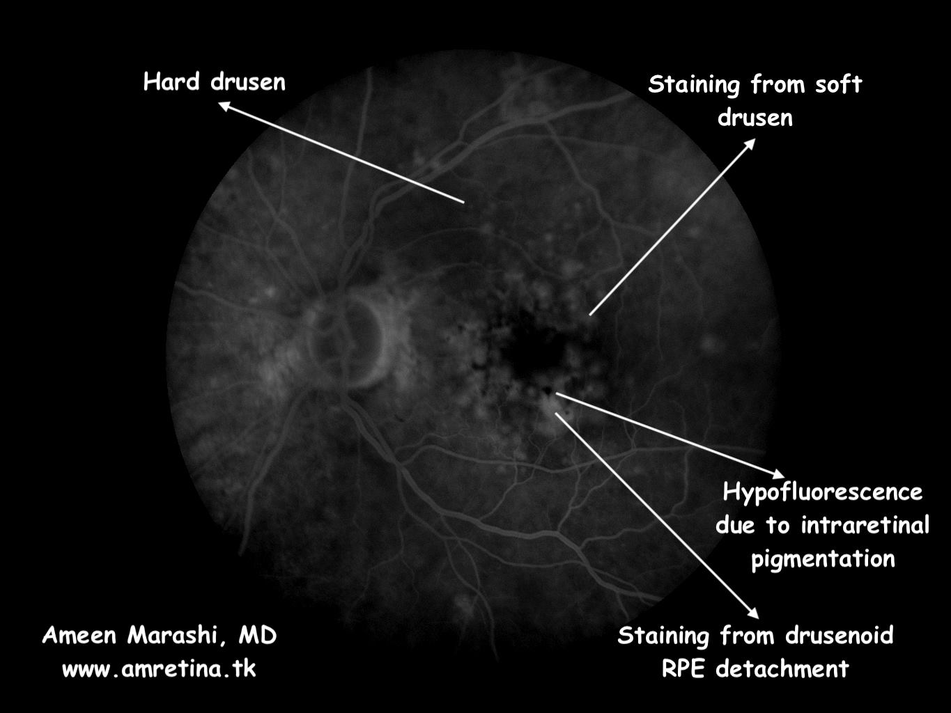 Fluorescein angiography features for drusen