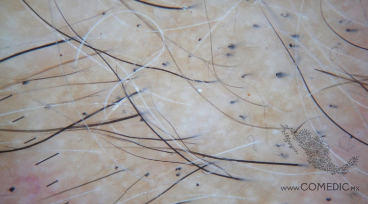 Comedic: Tricotilomanía